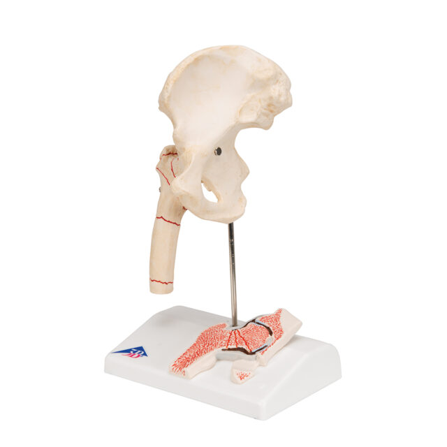 Femoral Fracture and Hip Osteoarthritis Anatomical Bone Model – Physio ...